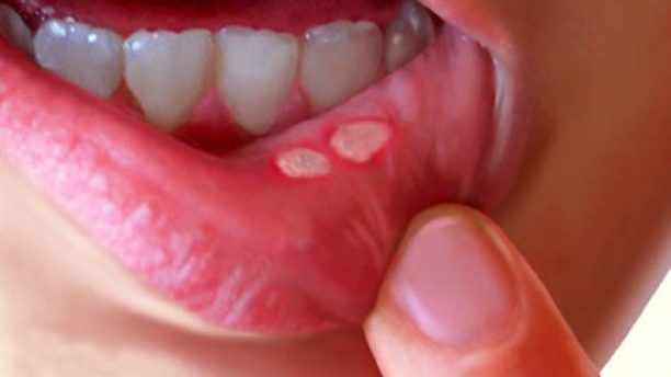 Les aphtes : Causes et traitements